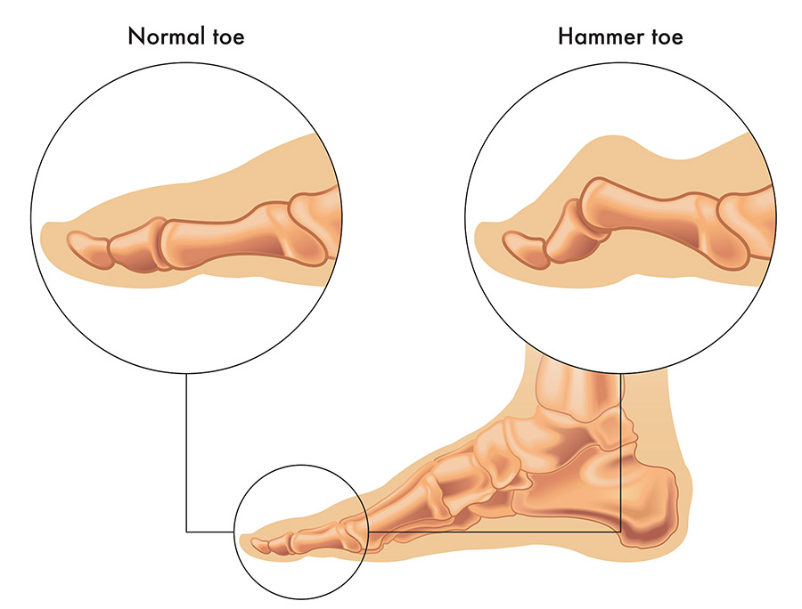 Hammer Toe Puget Sound Orthopaedics Hammer Toe Puget Sound Orthopaedics